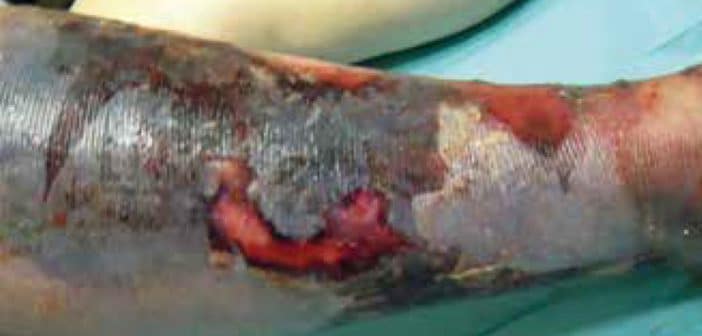 Fasciite nécrosante : comment la prendre en charge ? - Réalités ...