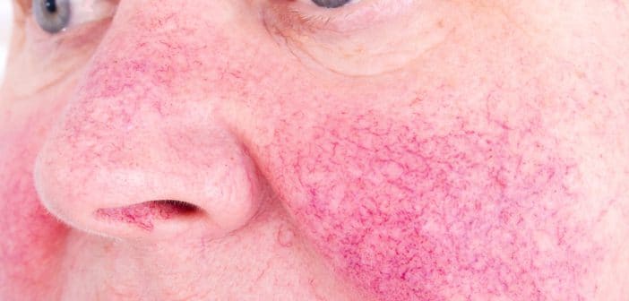 La rosacée oculaire - Réalités thérapeutiques en Dermato-Vénérologie