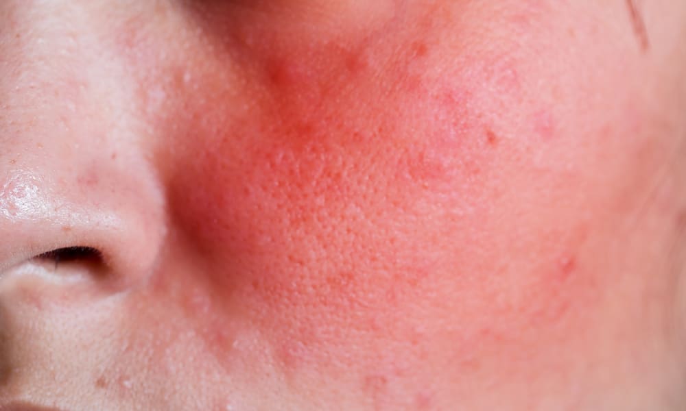 Contraception et lupus - Réalités thérapeutiques en Dermato-Vénérologie