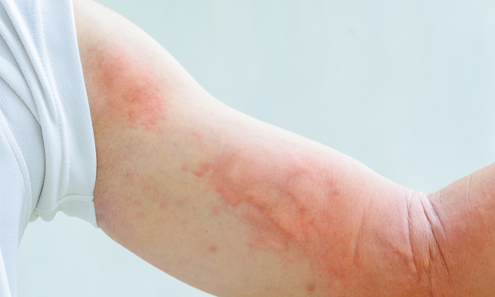 Traitement de l’urticaire chronique - Réalités thérapeutiques en ...