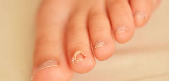 Dystrophies unguéales monodactyliques de l’enfant - Réalités ...