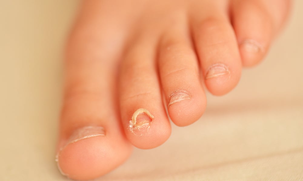 Dystrophies unguéales monodactyliques de l’enfant - Réalités ...