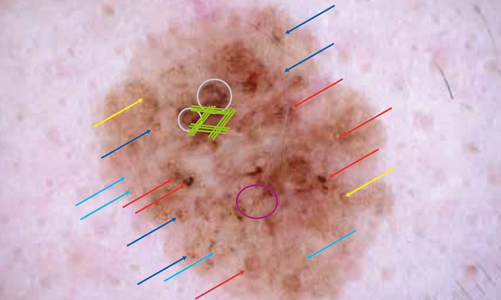 Fiche de dermoscopie n° 10 - Réalités thérapeutiques en Dermato-Vénérologie