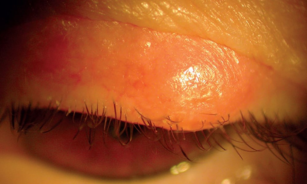 La rosacée oculaire est-elle la même maladie que la rosacée cutanée ...