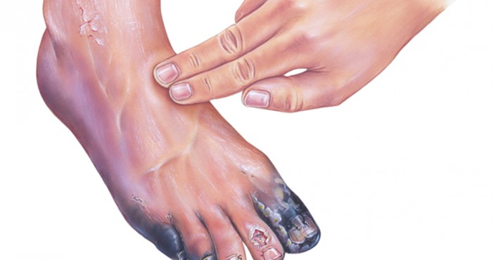 Archives des Dossier : Les acrosyndromes vasculaires - Réalités ...